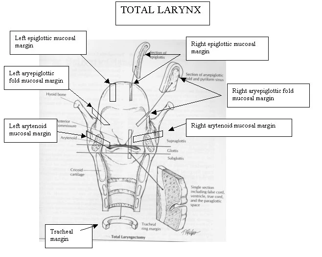 Laryngectomy - Pathology Resident Wiki